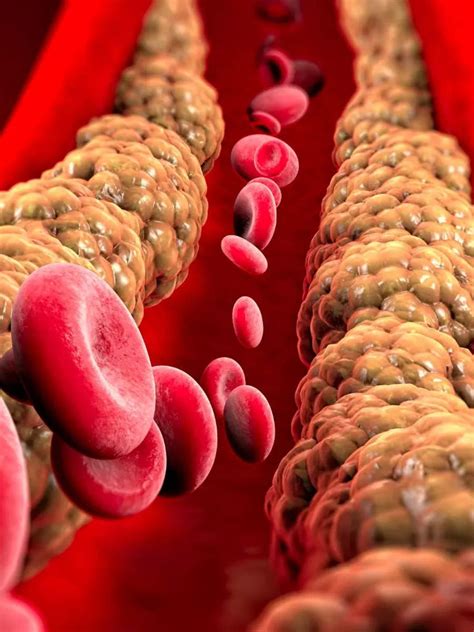 Top 5 Effortless Ways To Reduce Cholesterol Without Statins Times Now