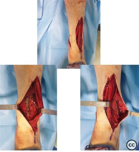 Open Medial Malleolus Fracture Dislocation With Tibial Pilon And