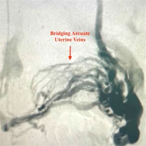 Catheterization Of The Left Ovarian Vein With After Contrast Injection Download Scientific
