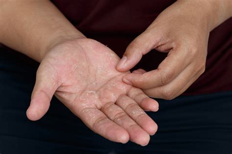 Foto De Mãos Secas Descascando A Pele Na Mão E Nos Dedos Alergia Ao Ar