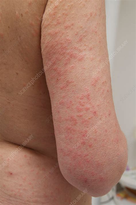 What Helps Polymorphic Light Eruption