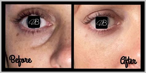 Can Tear Trough Filler Go Wrong