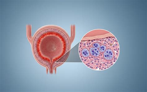 Cis Bladder Cancer Treatment Singapore Bladder Care