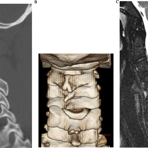 A Computed Tomography Ct Images Showing Left Facet Dislocation At Download Scientific