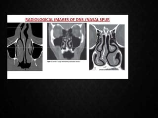 Anatomy Of Nose And Pns Pptx