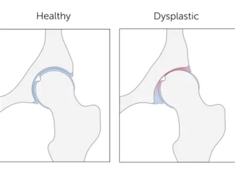 Developmental Dysplasia Of The Hip Treatment By Dr Roshan Kumar