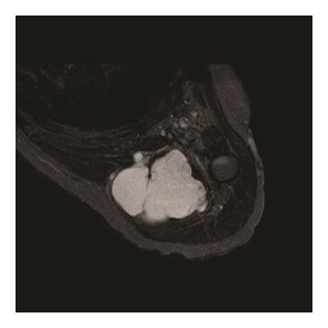 Stir And T2 Weighted Transverse Mri Observe The Huge Cystic Like