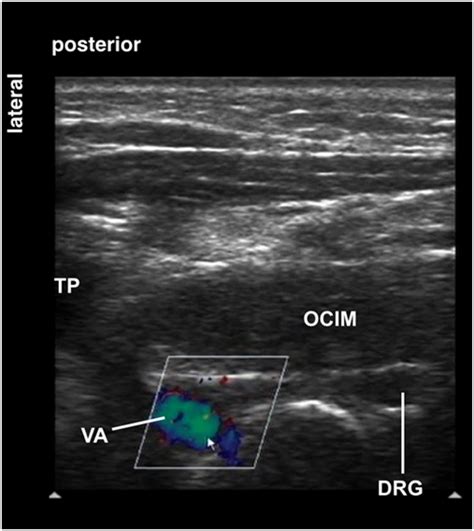 Usra Greater Occipital Nerve Block