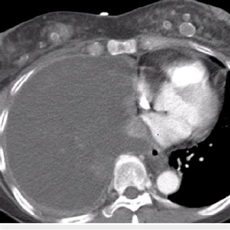 Computed Tomography Of The Chest Demonstrating A Large Right Sided