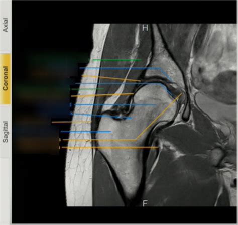 Coronal Hip Mri 9 Diagram Quizlet