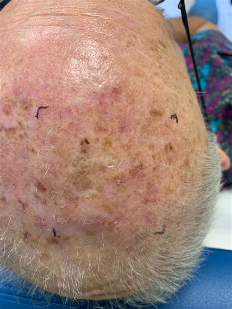 Actinic Keratosis Pictures Before After