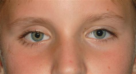 Removal Of An Eye Artificial Eyes And Socket Care Bopss