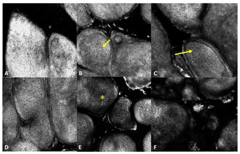 Non Invasive Imaging For The Diagnosis Of Genital Warts And Their Imitators