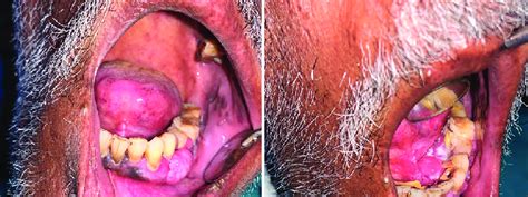 A Intraoral Photograph Showing A Gingival Swelling Extending From