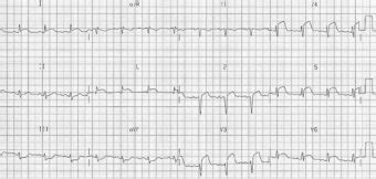 Anterior Myocardial Infarction • Litfl • Ecg Library Diagnosis