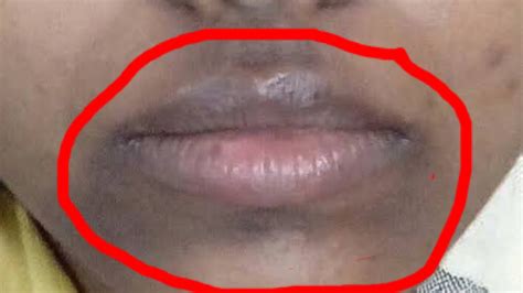 How To Get Rid Of Dark Spots On Lips Overnight Lipstu