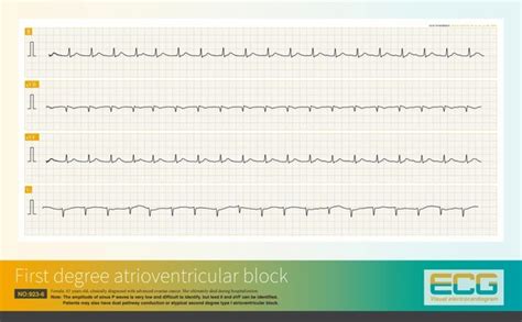 Arterial Flutter Over 6 Royalty Free Licensable Stock Illustrations
