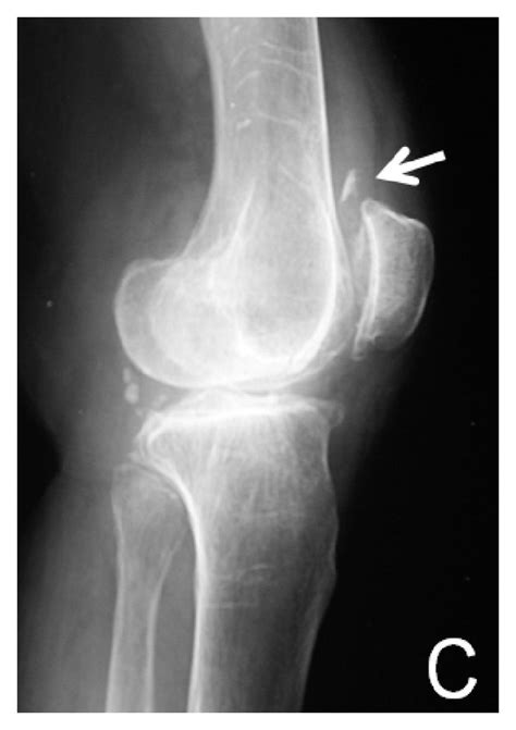 A Plain Frontal Radiography An Intra Articular Fracture Arrow Is Download Scientific