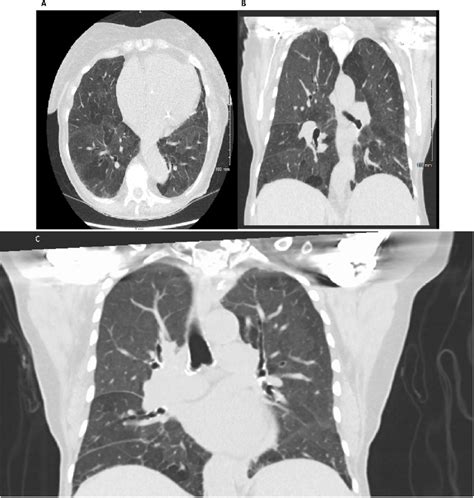 Ct Chest Showing Diffuse Mosaic Attenuation In The A Axial And B Download Scientific