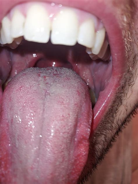 Is This Candidathrush Rcandida