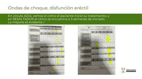 Ondas de choque para la discunción eréctil