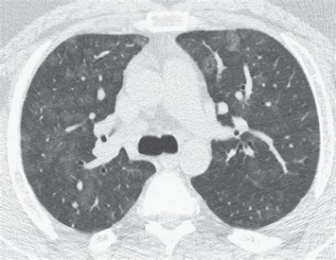 Thoracic Radiology Radiology Key