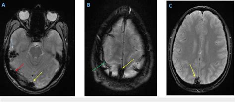 Magnetic Resonance Imaging Mri Of The Brainaxial Gradient Recall Echo