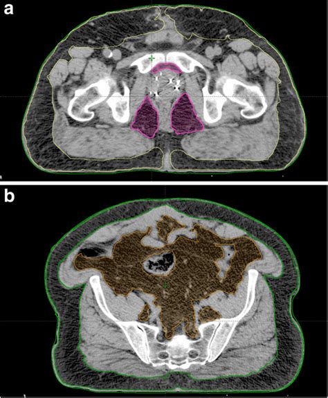 Adipose Tissue Measurements A Periprostatic Fat Pink And Download Scientific Diagram