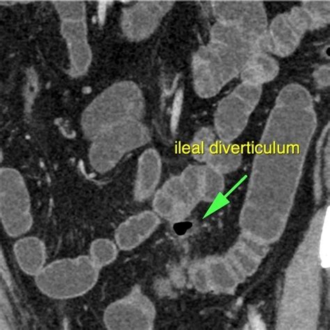 Small Bowel Diverticulitis Pacs