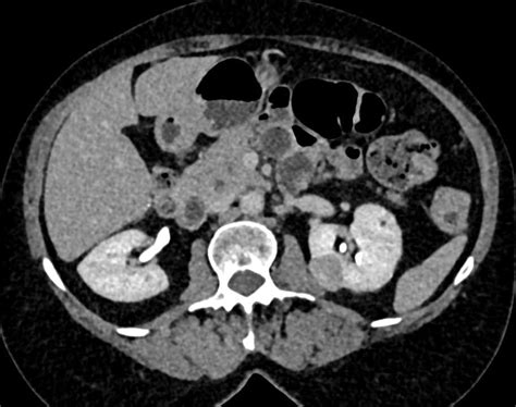 Hemangioma Liver Liver Radiology Case Studies Ctisus Ct Scanning