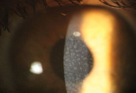 Meesmann Corneal Dystrophy