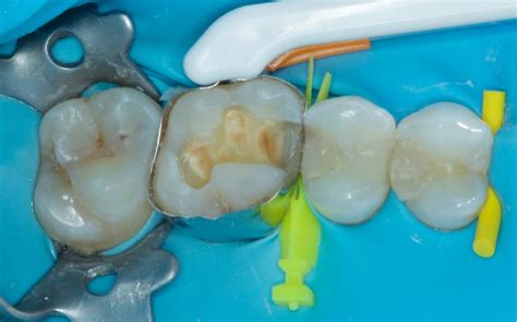Closing The Class 2 Restoration Box Part 2 Management Of Direct Resin