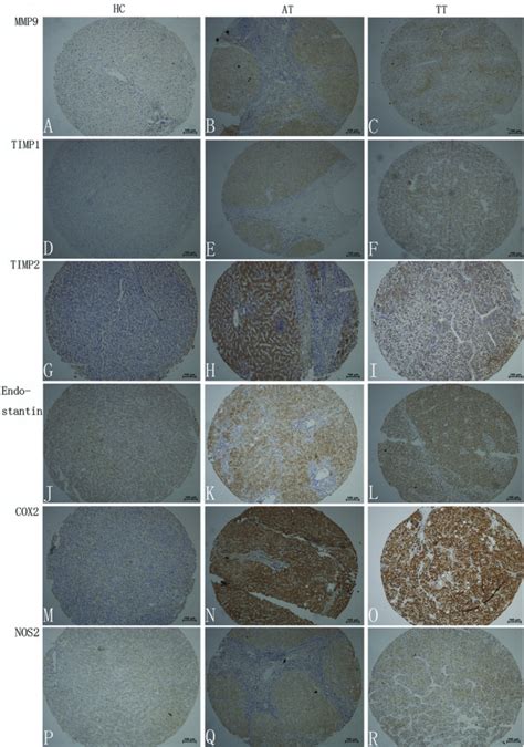 Immunohistochemical Staining Of Mmp 9 Timp 1 Timp 2 Endostatin