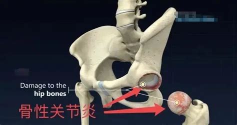 股骨头坏死经常被误诊为髋关节炎，两者如何区分？ 知乎