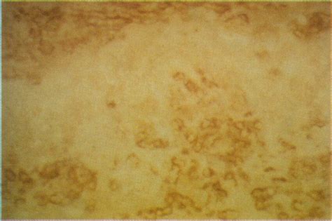 Egf Receptors In Formalin Fixed Paraffin Embedded Sections From A Gbm