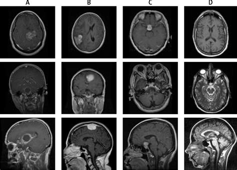 Brain Tumor Magnetic Resonance Images Classification Based Machine Learning Paradigms