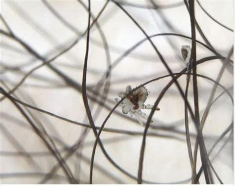 Man Catches Pubic Lice Without Having Sex And They Could Be Caught