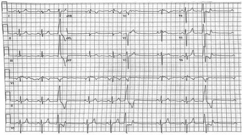 Electrocardiogram Showing Normal Sinus Rhythm Right Axis Deviation
