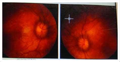 Dilated Fundus Color Photos Of The Patient Depicting Bilateral Optic