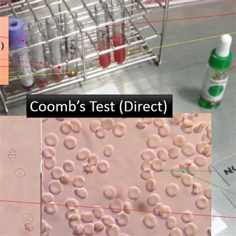 Coombs Test Direct Test Price In Delhi Cost Near Me India