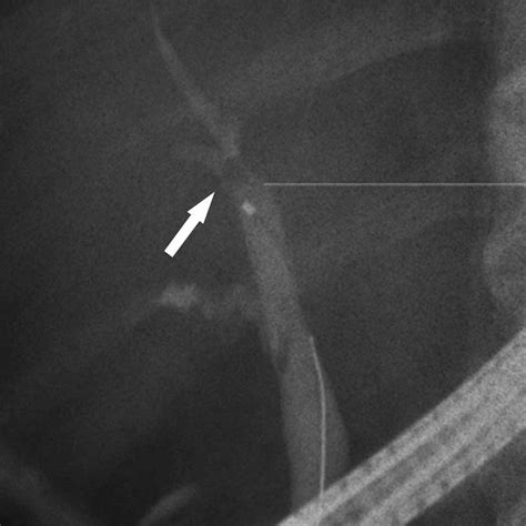 Preoperative Endoscopic Retrograde Cholangiopancreatography Showed A