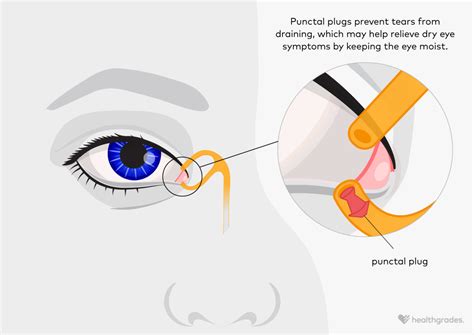 Punctal Plugs Purpose Procedure And Removal