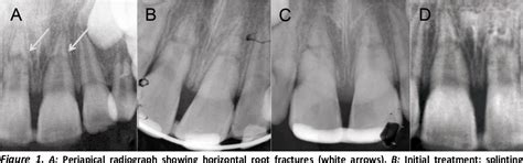 Figure 1 From Repair Of Horizontal Root Fracture A Case Report Semantic Scholar