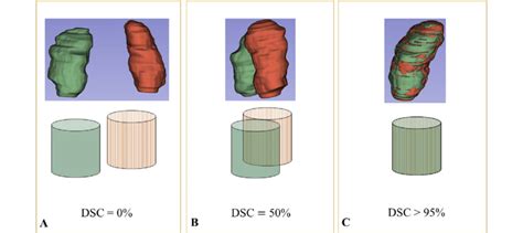 Graph Shows The Basic Principle Of Dice Similarity Coefficient Dsc Download Scientific