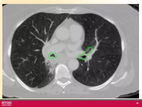 Rtog 1106 Oar Atlas Thoracic Radiation Therapy Ppt
