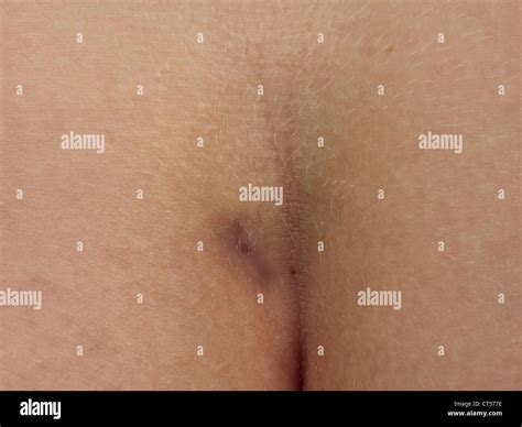 Cisti Pilonidale Immagini E Fotografie Stock Ad Alta Risoluzione Alamy