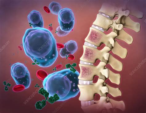 Multiple Myeloma Plasma Cells Stock Image C0365350 Science Photo