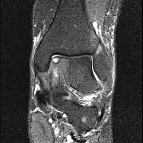 Osteochondral Defect Archives The Foot And Ankle Clinic