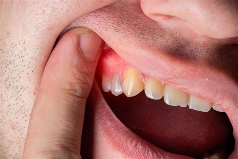 Why Replacing Lost Teeth Is Important
