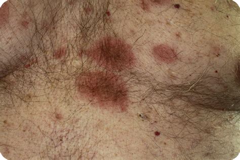 101 Eritema Fijo Pigmentario Medicamentoso Novartispro España